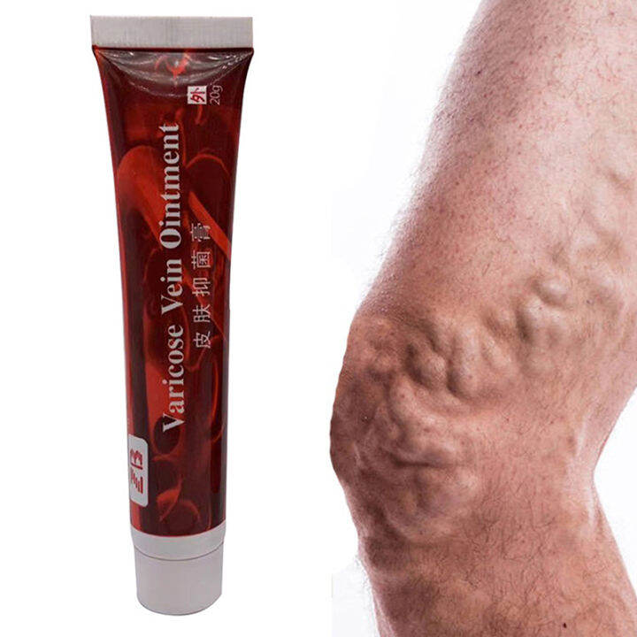 Health Beauty 30g Varicose Vein Ointment Vasculitis Phlebitis Treatment ...