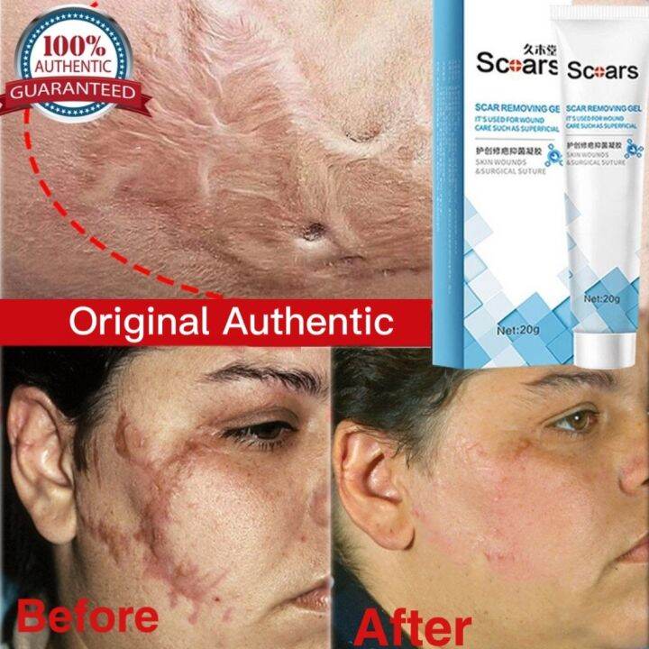scar remover for old scar on leg fix scar strechmark removal original ...