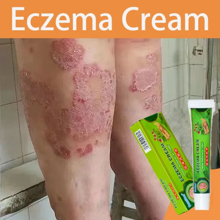 Eczema Cream Antibacterial And Antifungal Ointment Itchy Skin Tinea