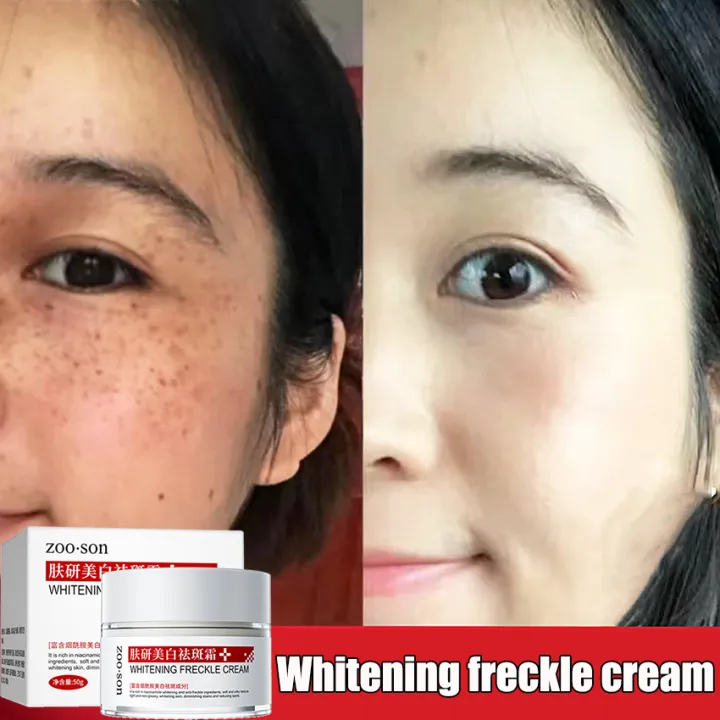Dark Spot Corrector Cream Whitening Freckle Cream Powerful Removing Melasma Melanin Dark Spots ...
