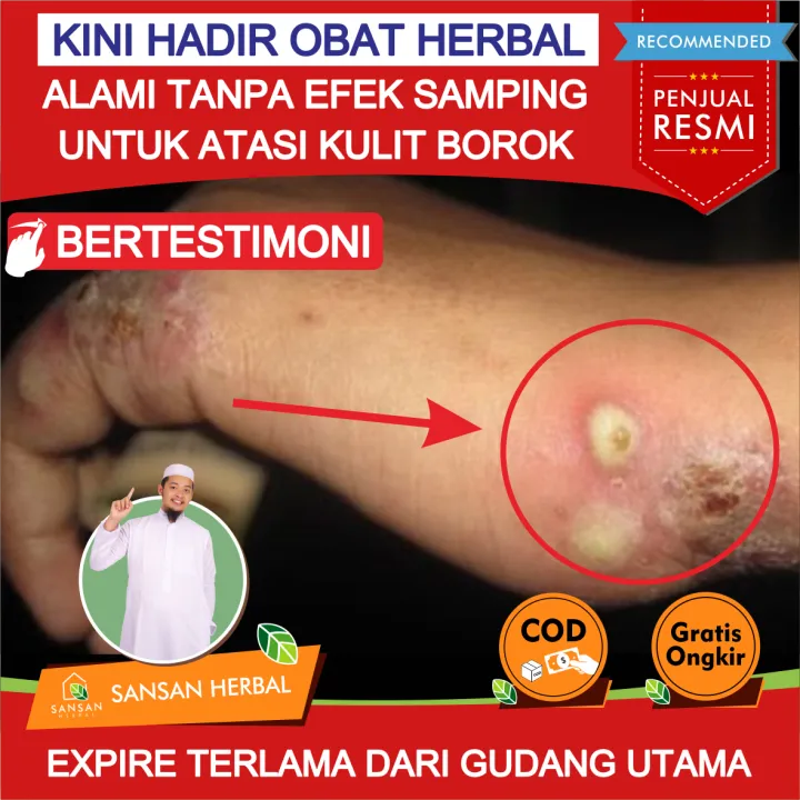 Obat Borok Bernanah Di Apotik, Borok Biar Cepat kering, Borok Parah ...
