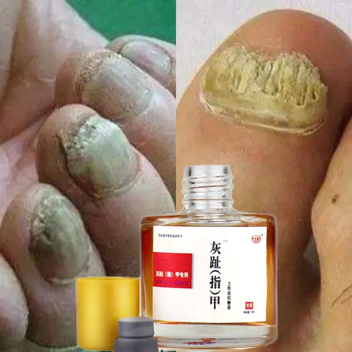 Nail Repair Essence Antibacterial liquid for onychomycosis Treats Nail ...