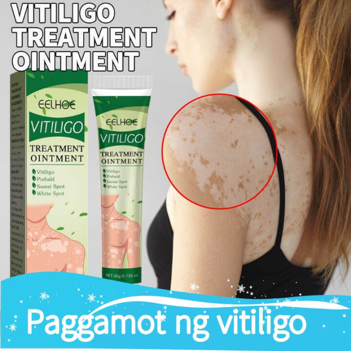 【COD】Vitiligo Cream White Spot Disease Repair Cream Treatment ...