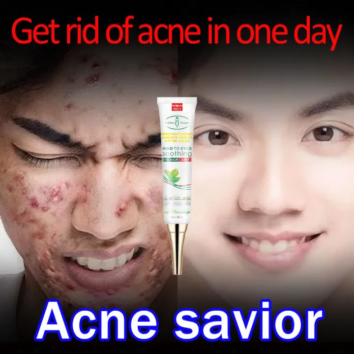 Acne cream pimple eraser Fade Dark Spots Treats Acne Remove Blemish ...