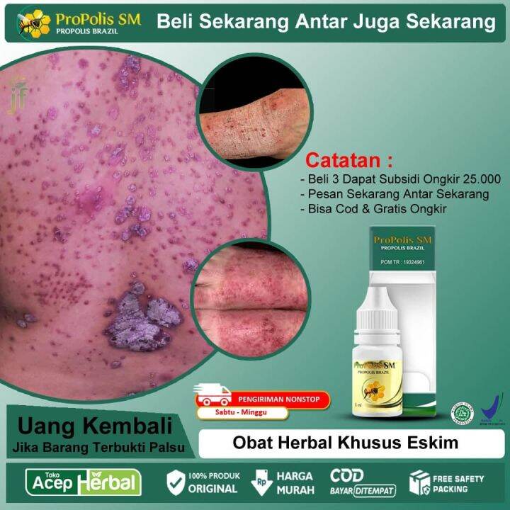 Obat Exim Kering Basah Gatal Selangkangan Darah Manis Kurap Kudis Panu ...