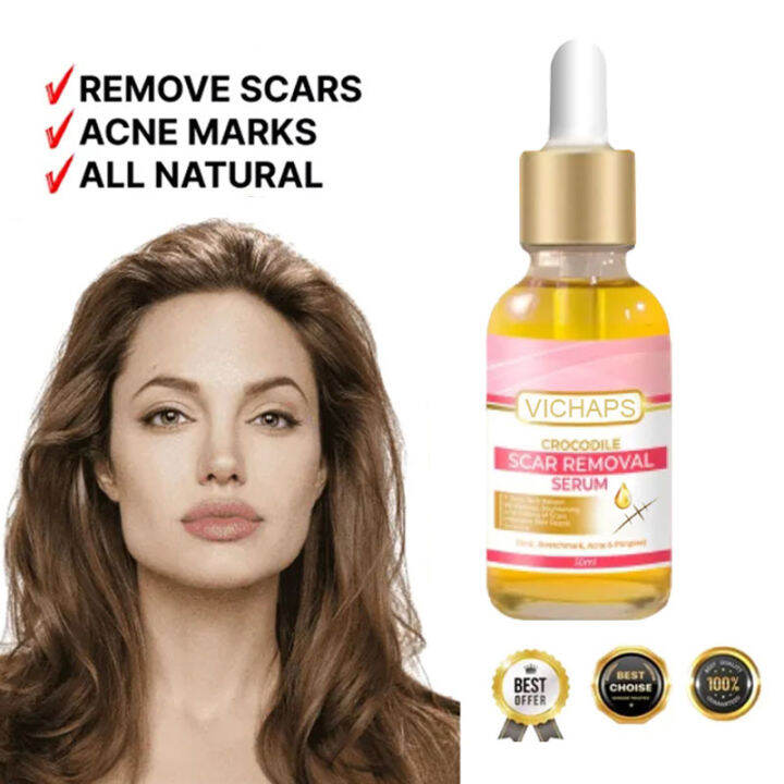 NATURI CROCODILE SCARE REMOVAL SERUM scar remover Scar Removal Time ...