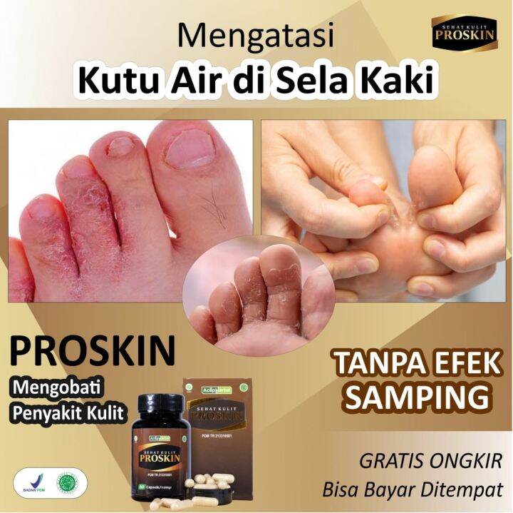 Obat Kutu Air Pada Sela Jari Kaki Rangen Untuk Kutu Air Ditangan Dan ...