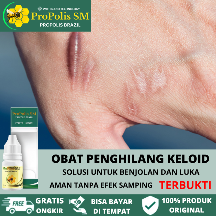 Obat Herbal Keloid Membesar, Keloid Di Bawah Perut Pasca Operasi Sesar ...