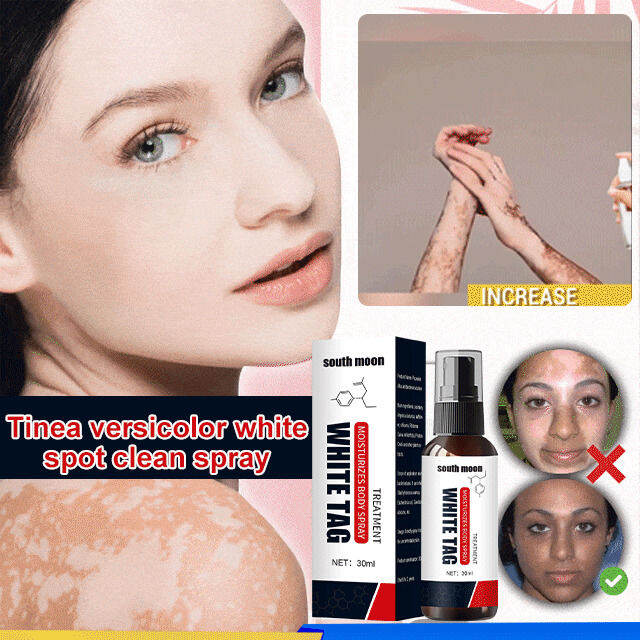 Vcool Tinea Versicolor White Spot Vitiligo Clean Spray 30ml | Lazada PH