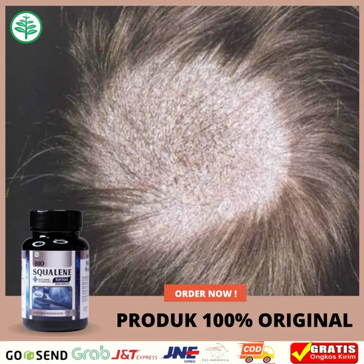 Obat Jamur Kepala ( Tinea Kapitis ), Penghilang Infeksi Jamur di Kepala ...