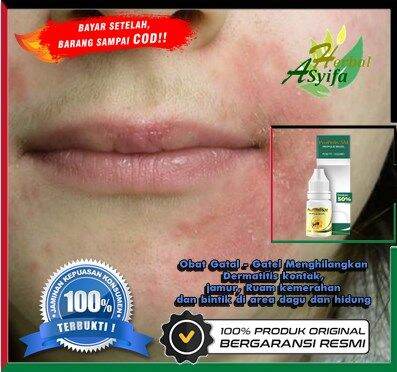 Obat Gatal - Gatel Menghilangkan Dermatitis kontak, Infeksi Kulit Jamur ...