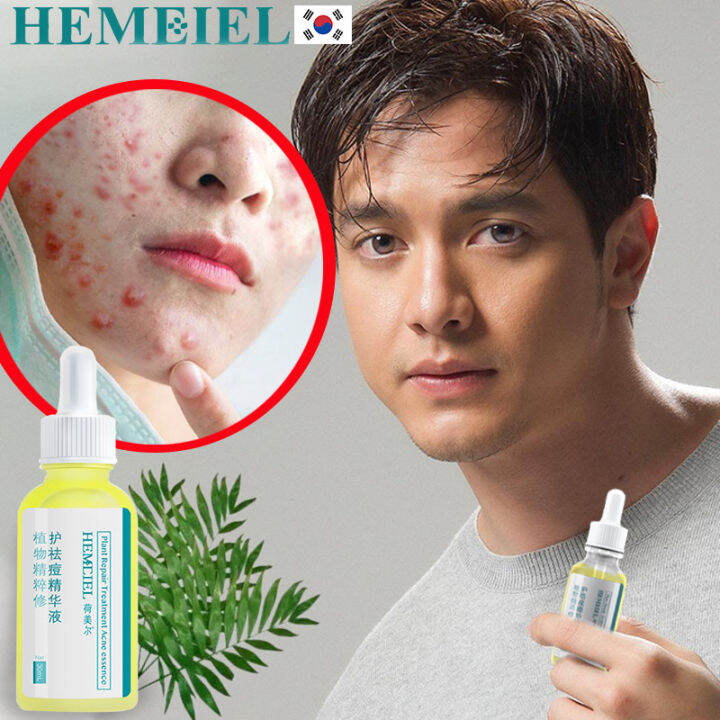 HEMEIEL Pimple Eraser Quick Fx/Acne Remover/Anti Acne And Pimples ...