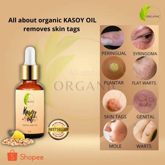 PURE Kasoy Oil for Warts Skin Tags Skin Growth Mole Remover Nunal ...