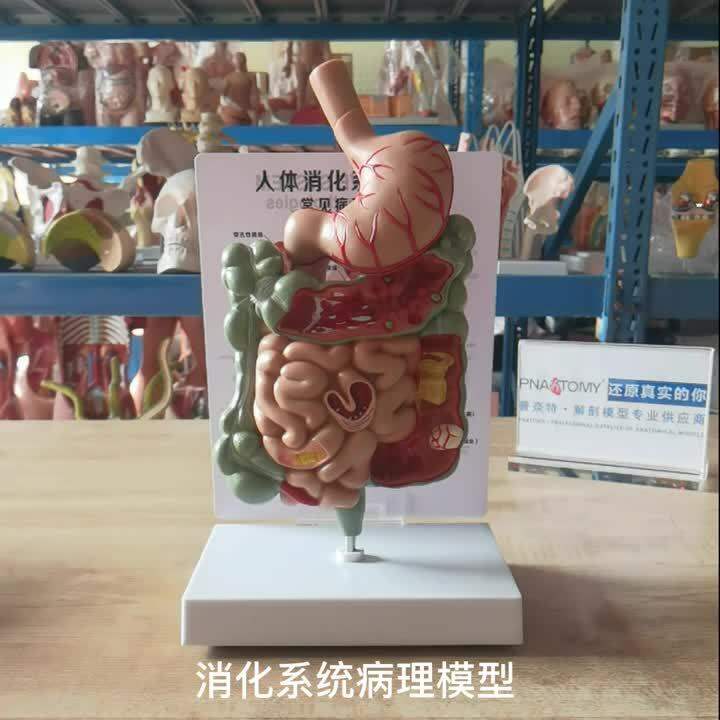 GI TRACT Model Diseased Digestive System Stomach Anatomy Small and ...