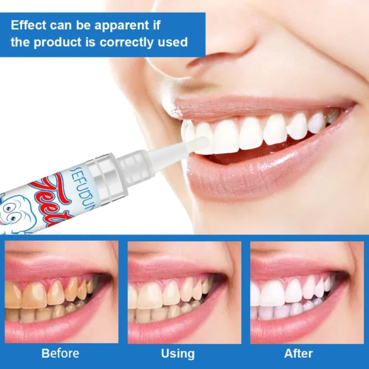 SEFUDUN Tooth Whitening Gel Pen Dazzling White Get Rid of Yellow Teeth ...