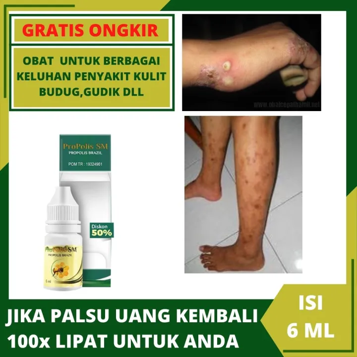 Obat Budug (BPOM) Koreng Di Kaki - Borok Di Kaki - Gatal Di Kaki ...