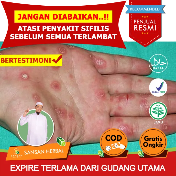 Obat Sifilis Raja Singa, Obat Sifilis Pria, Obat Sifilis Wanita, Obat ...