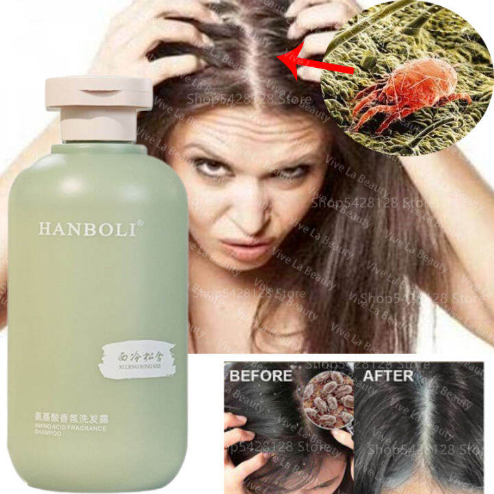 ( Shampoo + Conditioner set) anti-dandruff shampoo set Amino Acid Sea Salt Shampoo Mite Removal ...