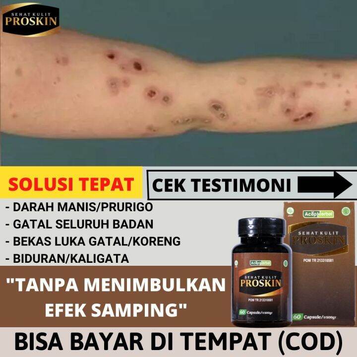 Sehat Kulit Proskin Obat Prurigo Darah Manis - Obat Bintik Hitam Bekas ...