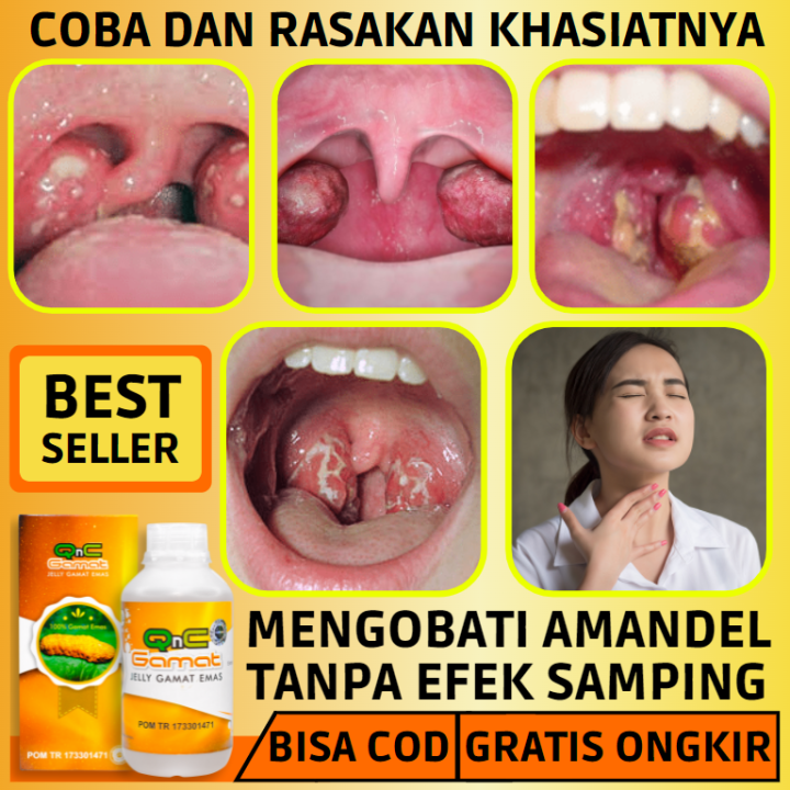 Obat Herbal Amandel Bengkak Radang Amandel Kronis Membengkak Faringitis ...