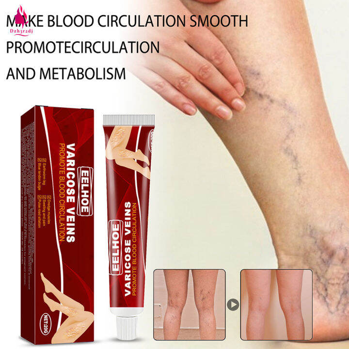 OH-Beauty Krim Varises, Salep untuk Perawatan Kaki Efektif Vaskulitis ...