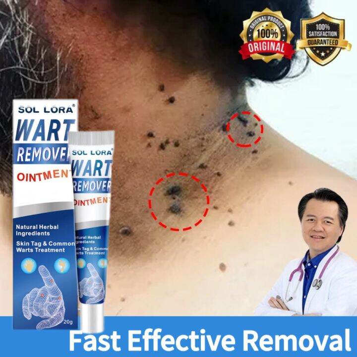 【Effective in 7 days】Warts Remover Original Cream 20g Filiform Warts ...