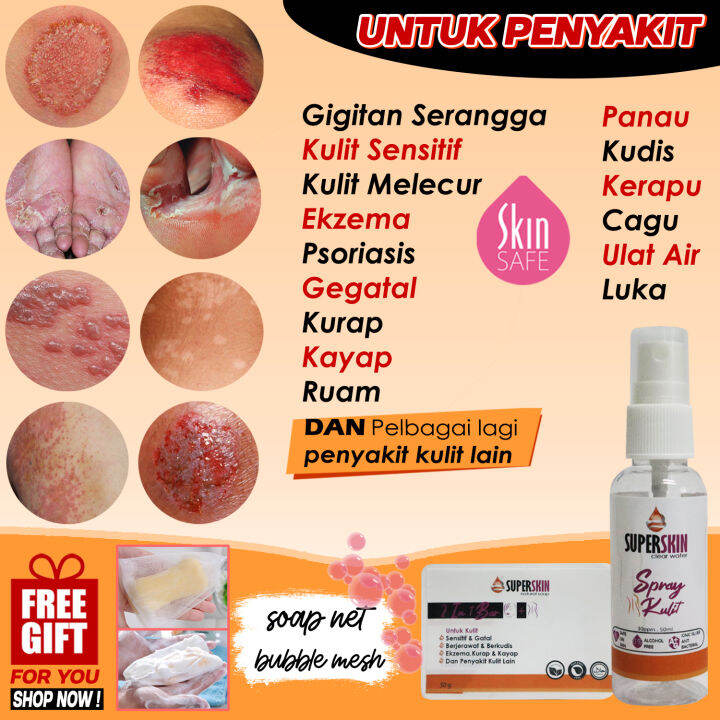 Ubat Kurap Gatal Kayap Kulit Sensitif Kudis Psoriasis Scabies Itchy ...