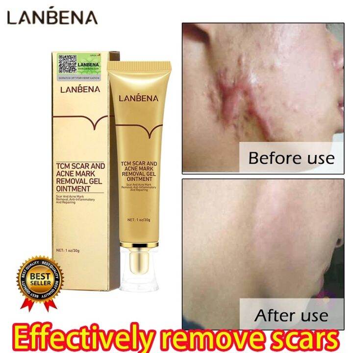 LANBENA Original TCM Acne Scar Removal Cream Blackhead Pimple Stretch ...