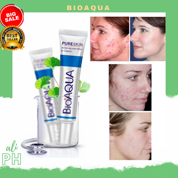 Ali Ph Bioaqua Acne And Pimples Removal Cream Acne Scar Mark Remover
