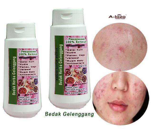 Bedak Herba powder Gelenggang untuk ruam gatal panau kurap kudis cagu ...