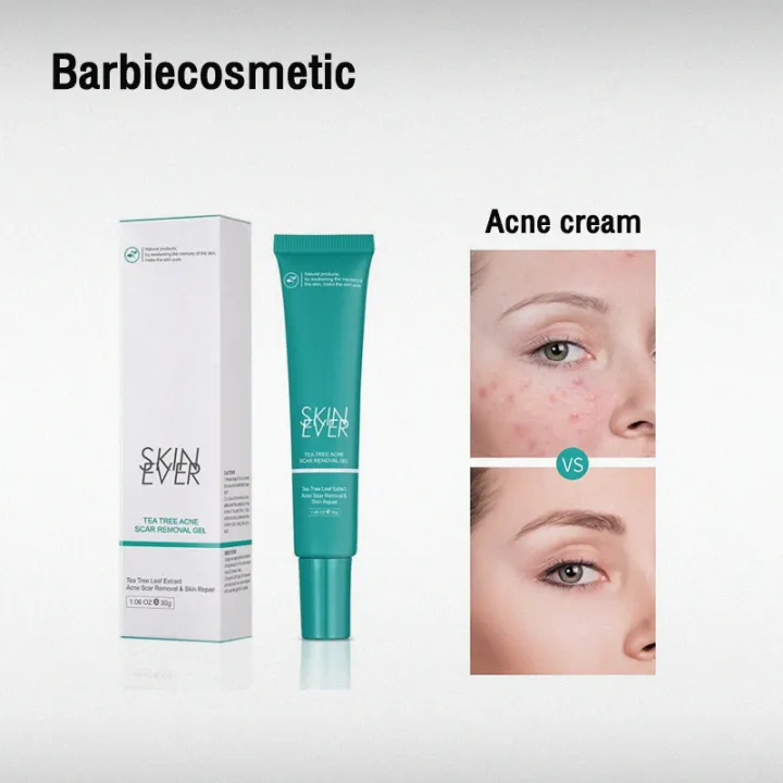 SKIN EVER get rid of white, clogged acne, pimples, no head, acne holes ...