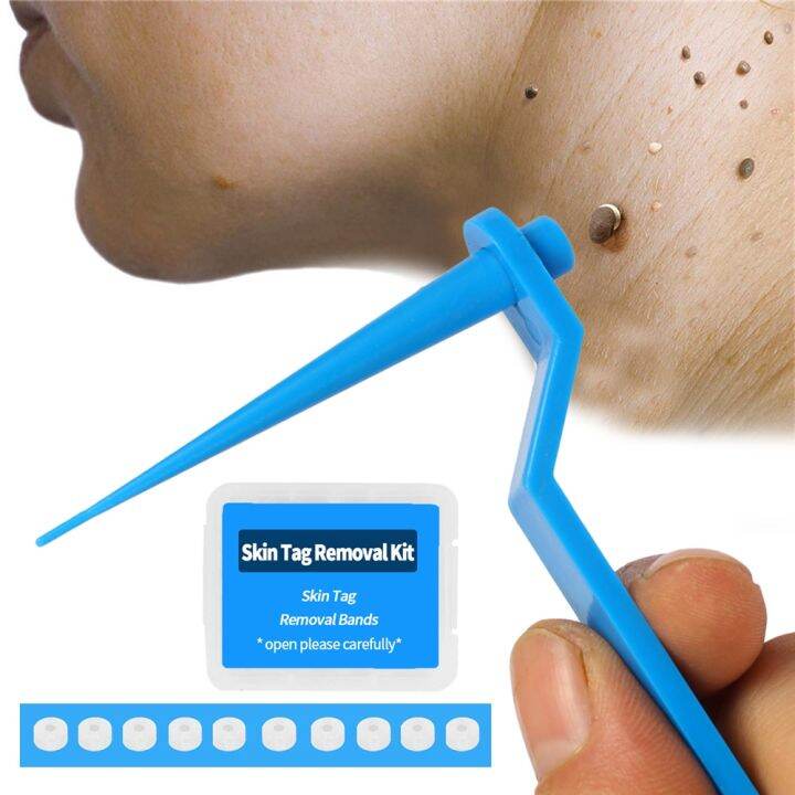 [Universal] Medical Skin Tag Kill Skin Mole Wart Remover Micro Band ...