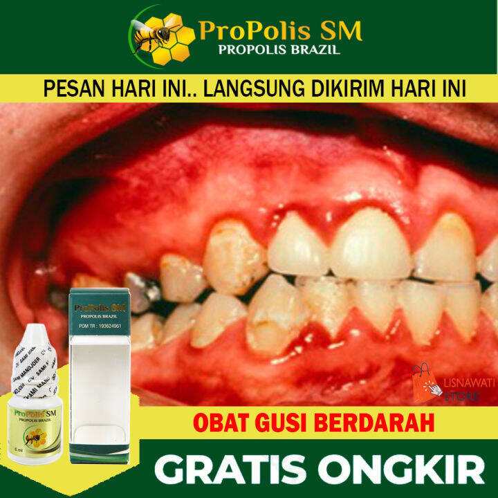 Obat Gusi Berdarah, Gusi Bernanah, Gusi Sakit, Gusi Ngilu, Gusi Bengkak ...