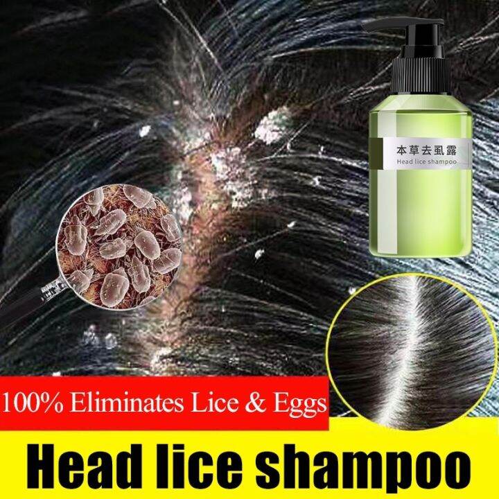 Head lice aliz remover shampoo for adult kids removal licealiz eggs for ...