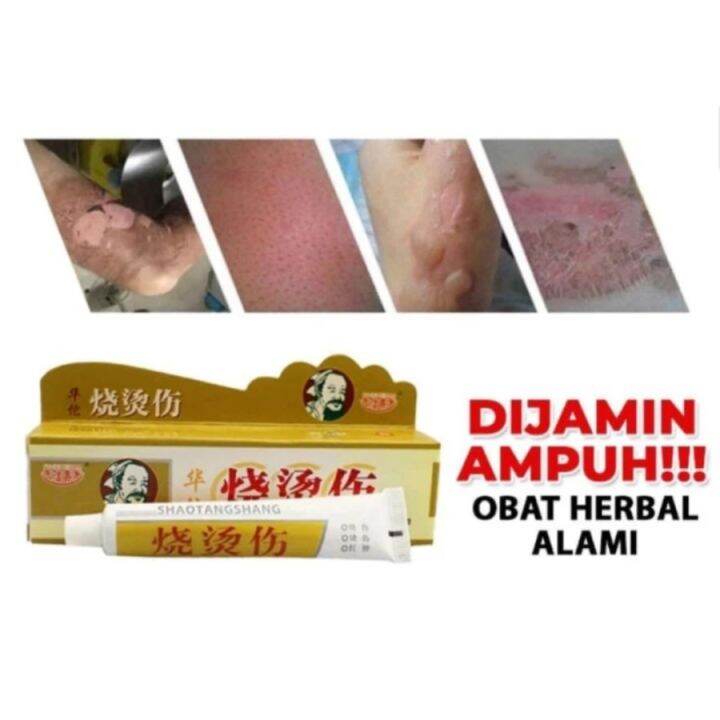 salep luka bakar hua tuo shao tang shang cream original terbaik ...