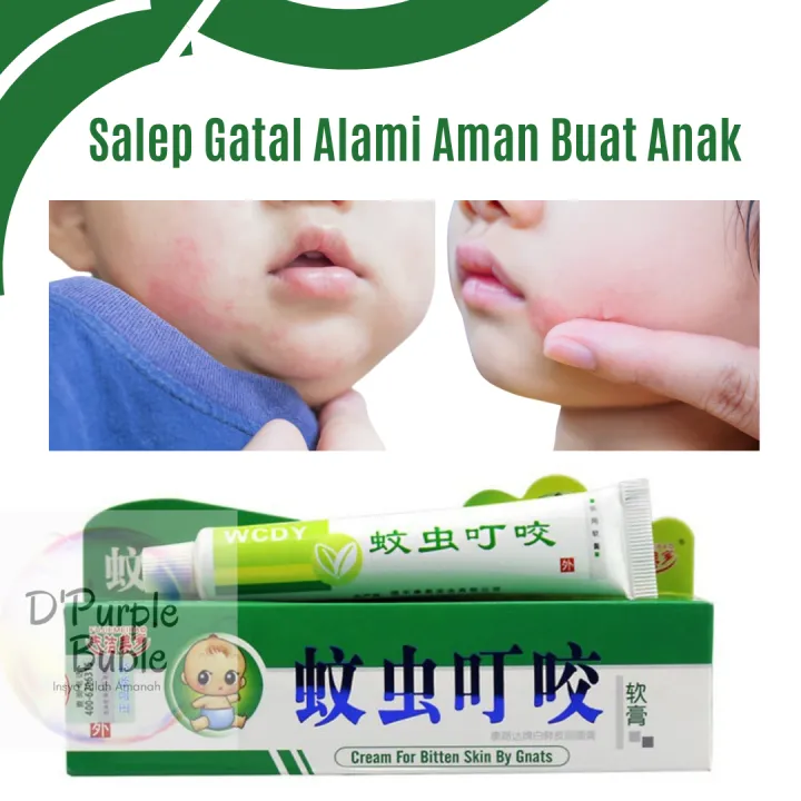 Obat Gatal Anak 4 Tahun 7 Th Salep Jamur Kulit Buat Anak Balita Baby ...