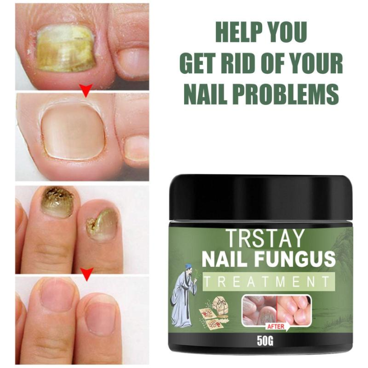 Nail Fungus Removal Cream Nail Care Ointment Anti-infection for ...