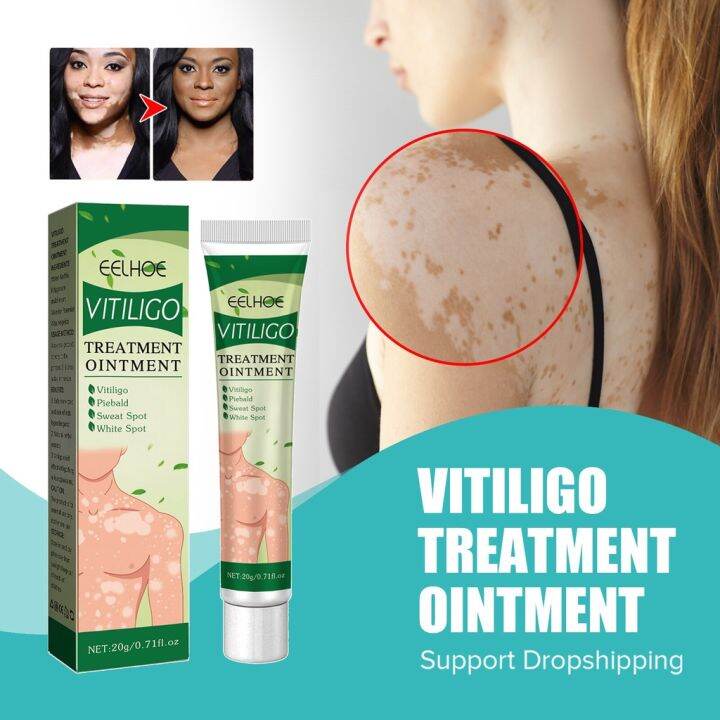 vitiligo skin treatment cream vitiligo remover white spot removal cream ...