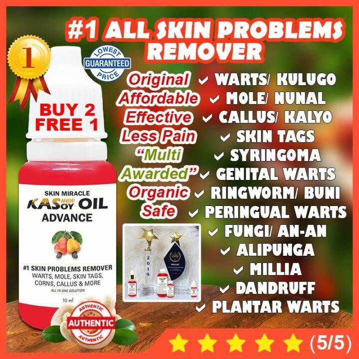 No.1 Warts Remover Kulugo Skin tag Mole/Nunal Kalyo More - Affordable ...