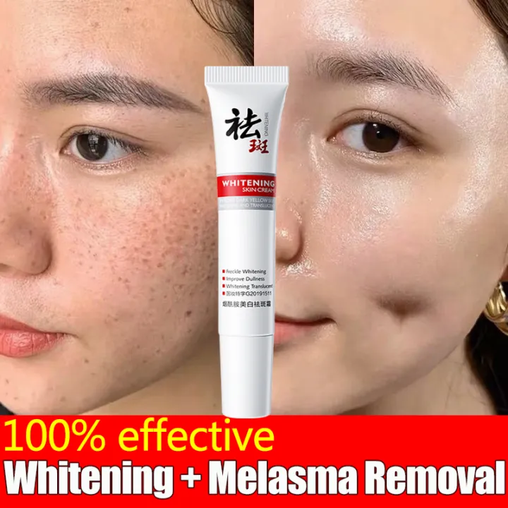 ZHIDUO Genuine Freckle Removal Whitening Cream Original Facial ...