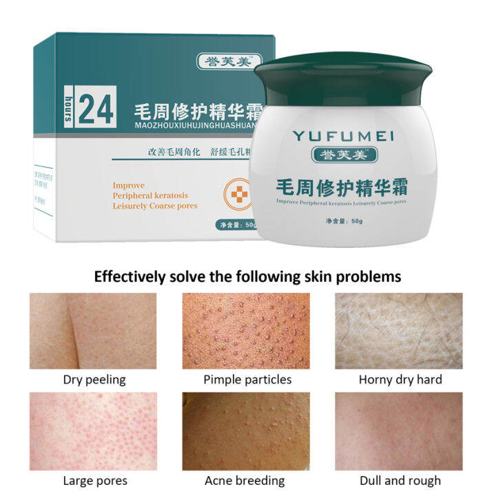 50g Curing Keratosis Pilaris Kp Chicken Skin Body Lotion Skin Repair