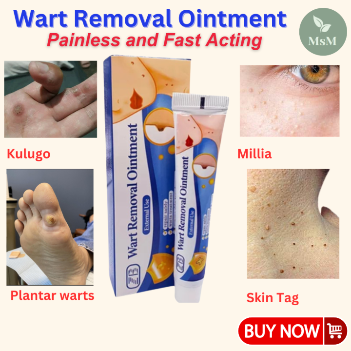 MsM Wart Removal Ointment Cream - Fast & Effective Skin Tags and Warts ...