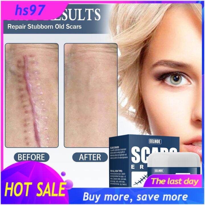 Hot 】scar Remover For Old Scar On Leg Bio Oil Stretch Mark Remover