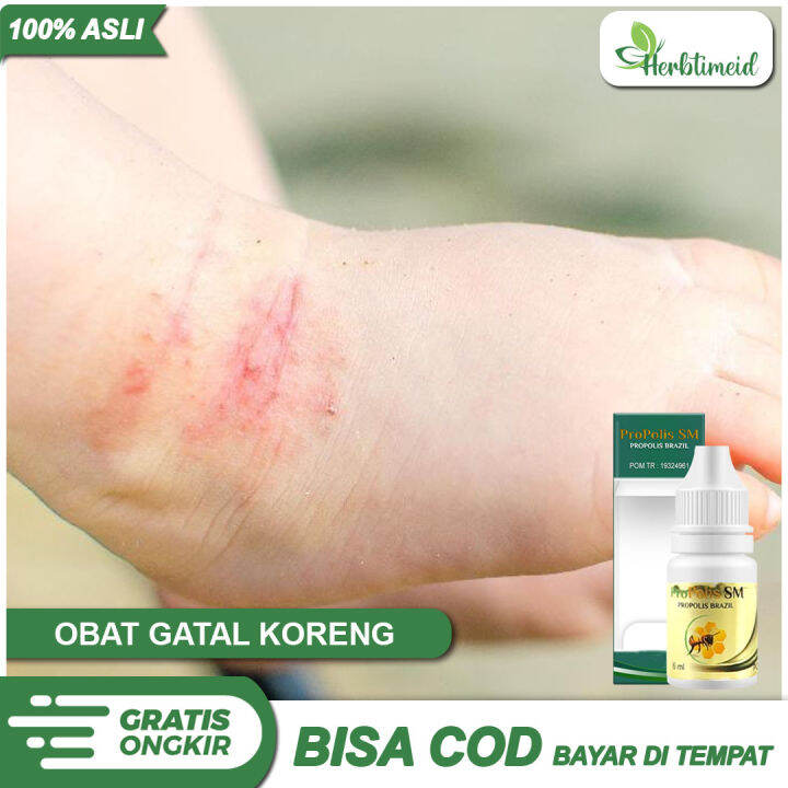 Obat Gatal Koreng untuk Anak dan Dewasa - Borok Bernanah - Gatel2 Kulit ...