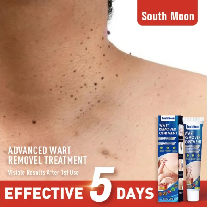EFFECTIVE warts remover original cream Warts and Skin Tags Remover mole ...