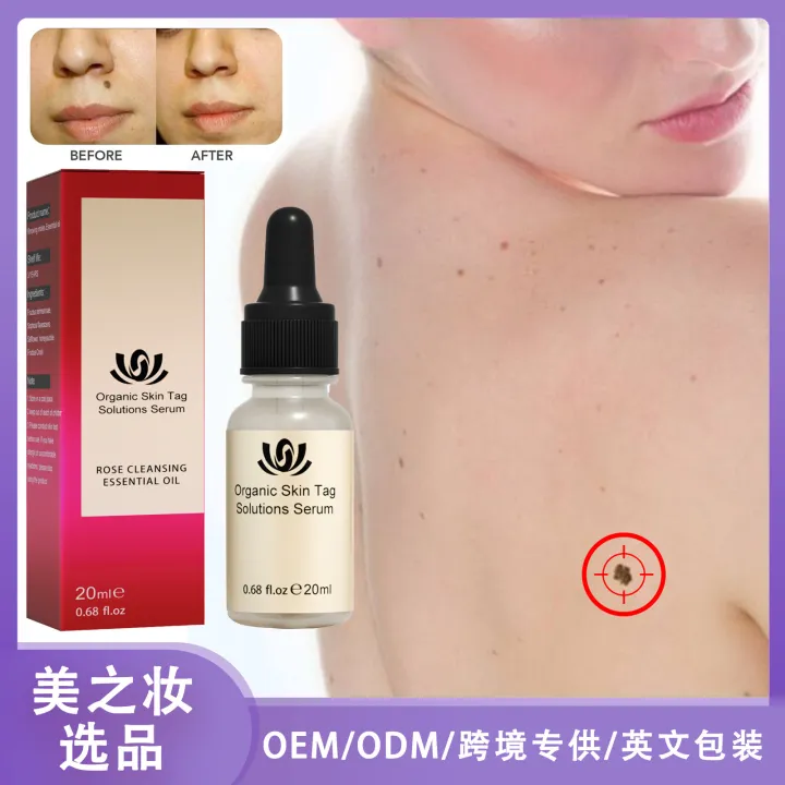 Mole Removal Liquid Traceless Spot Black Mole Essence Keru Removing ...