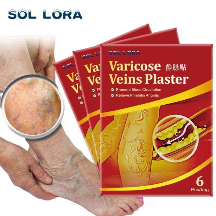 Varicose Veins Treatment Blood Vessel Swelling Spider Leg Vasculitis ...