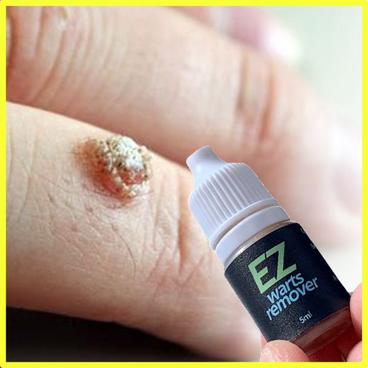 EZ WARTS Remover ORIGINAL Authentic for Warts Moles Skin Tags Nunal NOT ...
