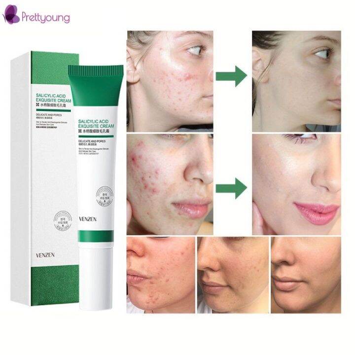 Prettyoung Salicylic Acid Acne Remove Acid Acne Cream 20g Blackhead ...