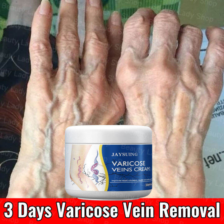 Just 3 days Varicose Vein Removal Cream Original varicose veins ...